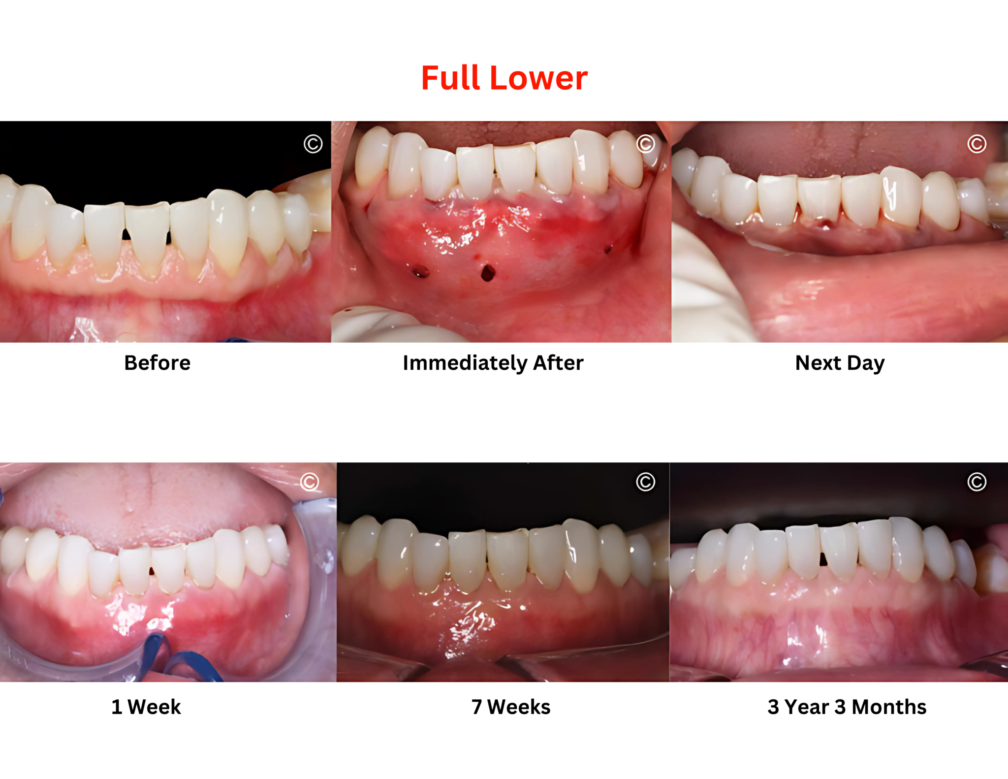 Pinhole Surgical Technique | Minimally Invasive | Dental CE Course