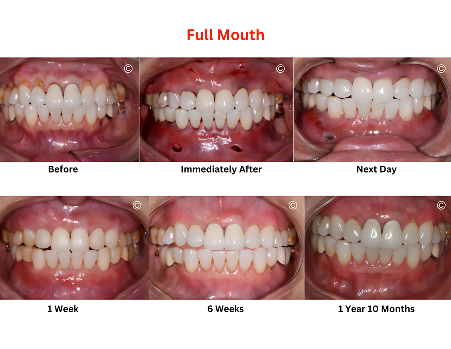 Pinhole Surgical Technique | Minimally Invasive | Dental CE Course
