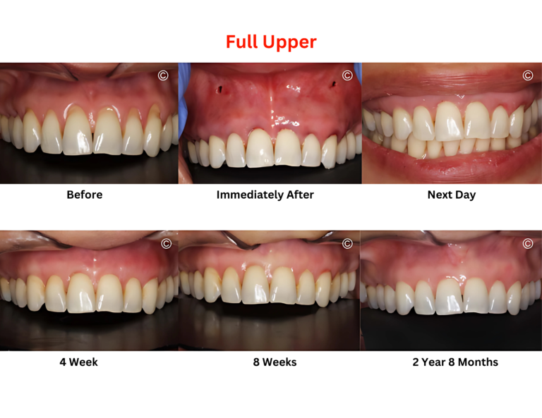 Pinhole Surgical Technique | Minimally Invasive | Dental CE Course
