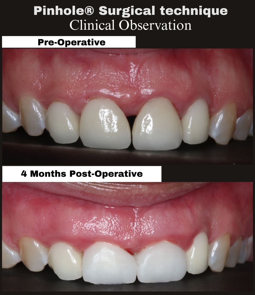 Clinical Observation — Gingival Recession - Pinhole® Surgical Technique